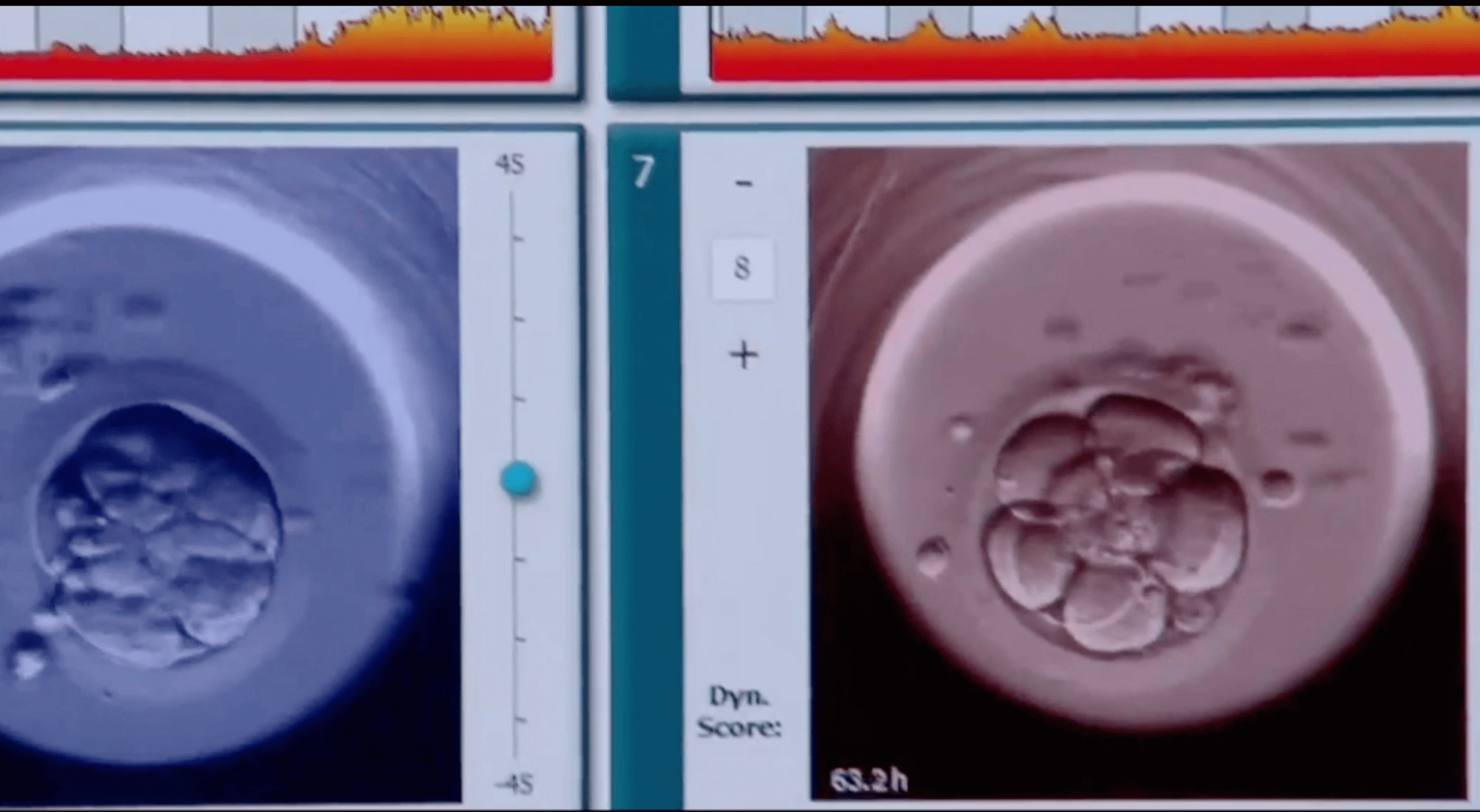 Focus on Fertility Ep3: Embryo Technology to Select a Better Embryo ...